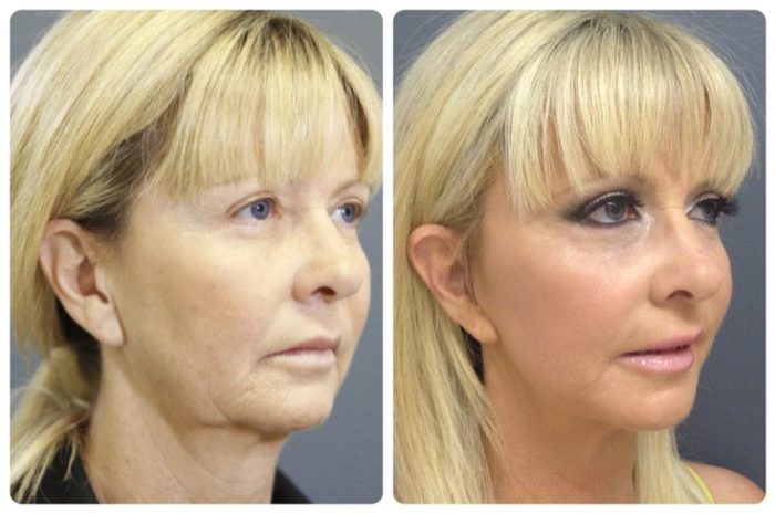 All That You Must Know About Mini Facelift Surgery - The Plastic Surgeons